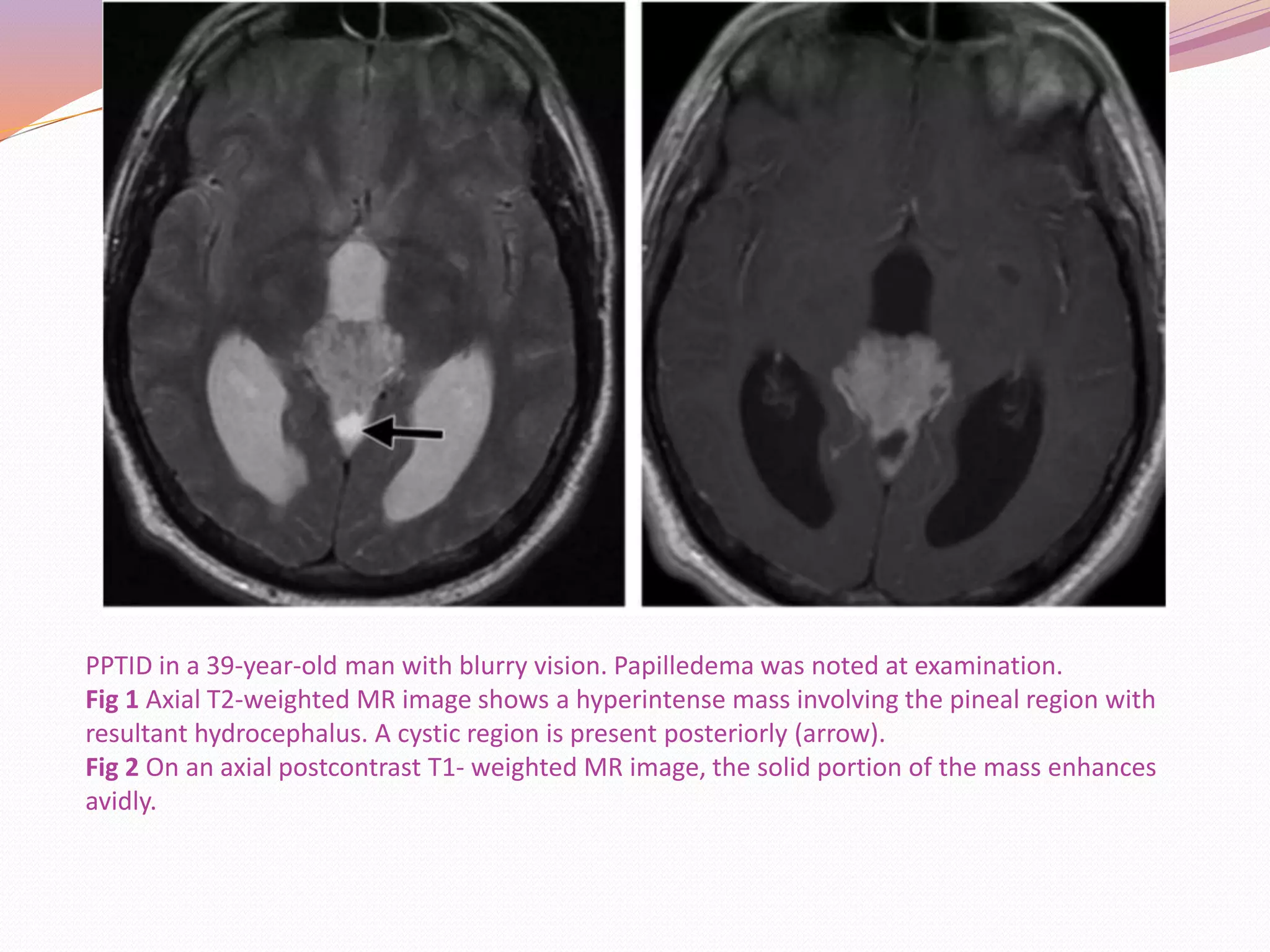 Pineal region tumors | PPTX