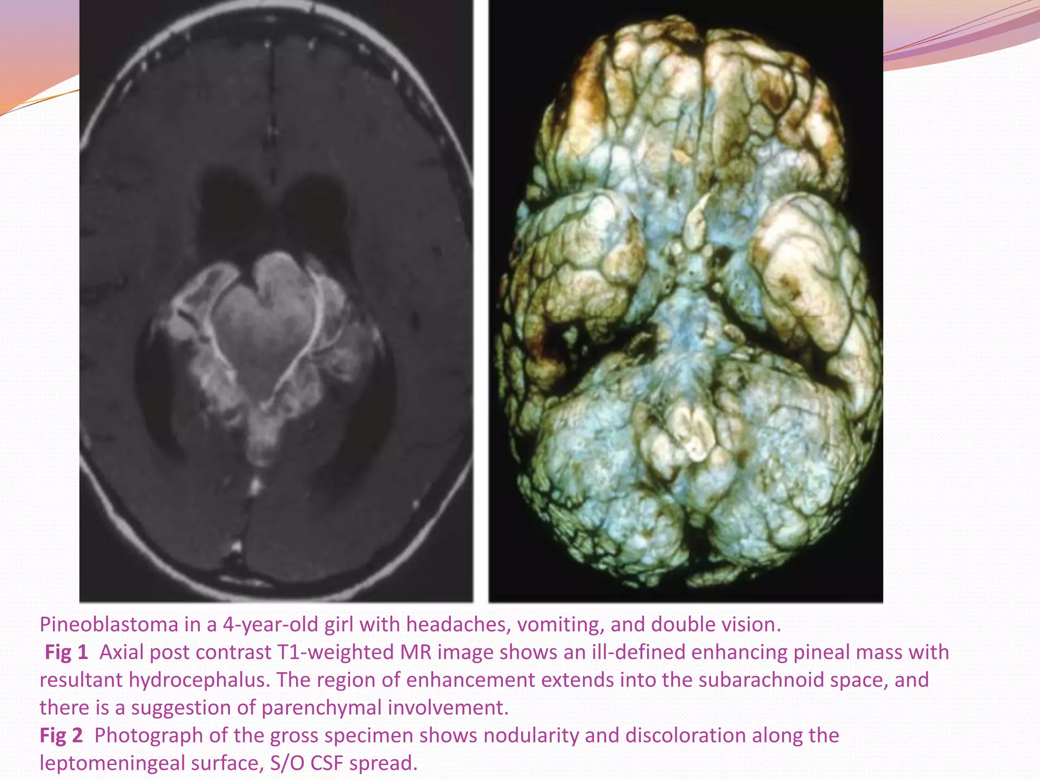 Pineal region tumors | PPTX