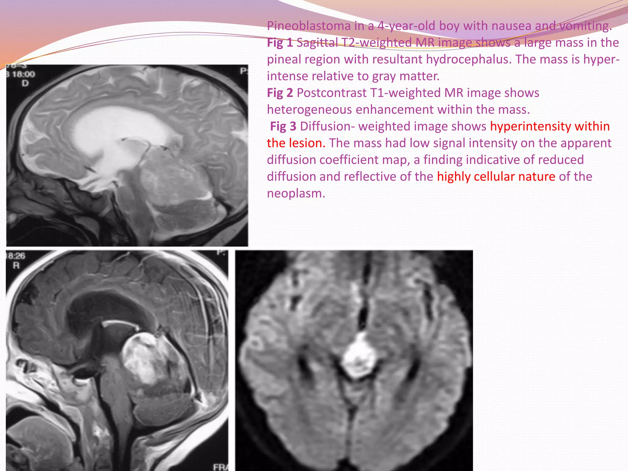 Pineal region tumors | PPTX