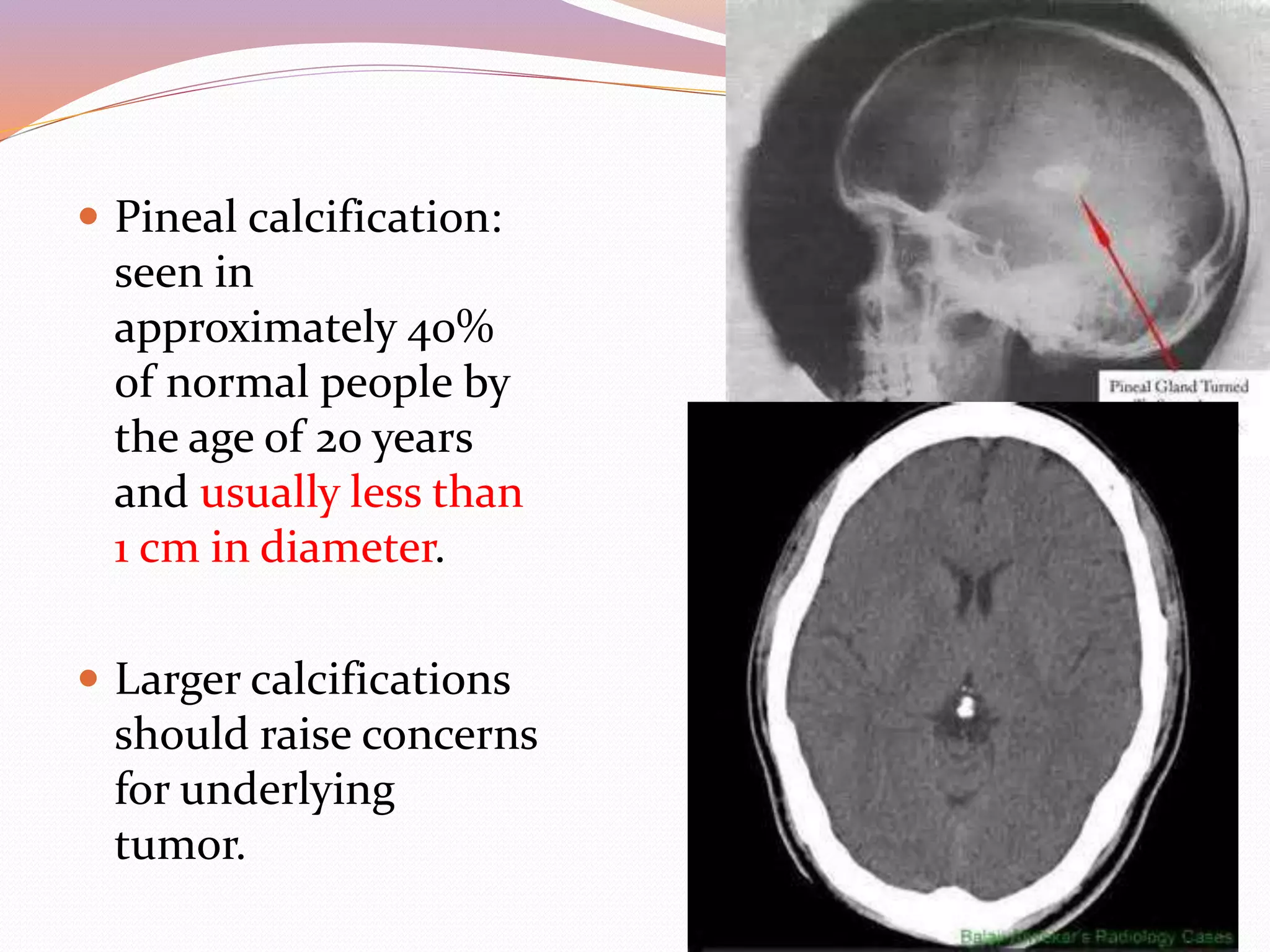 Pineal region tumors | PPTX
