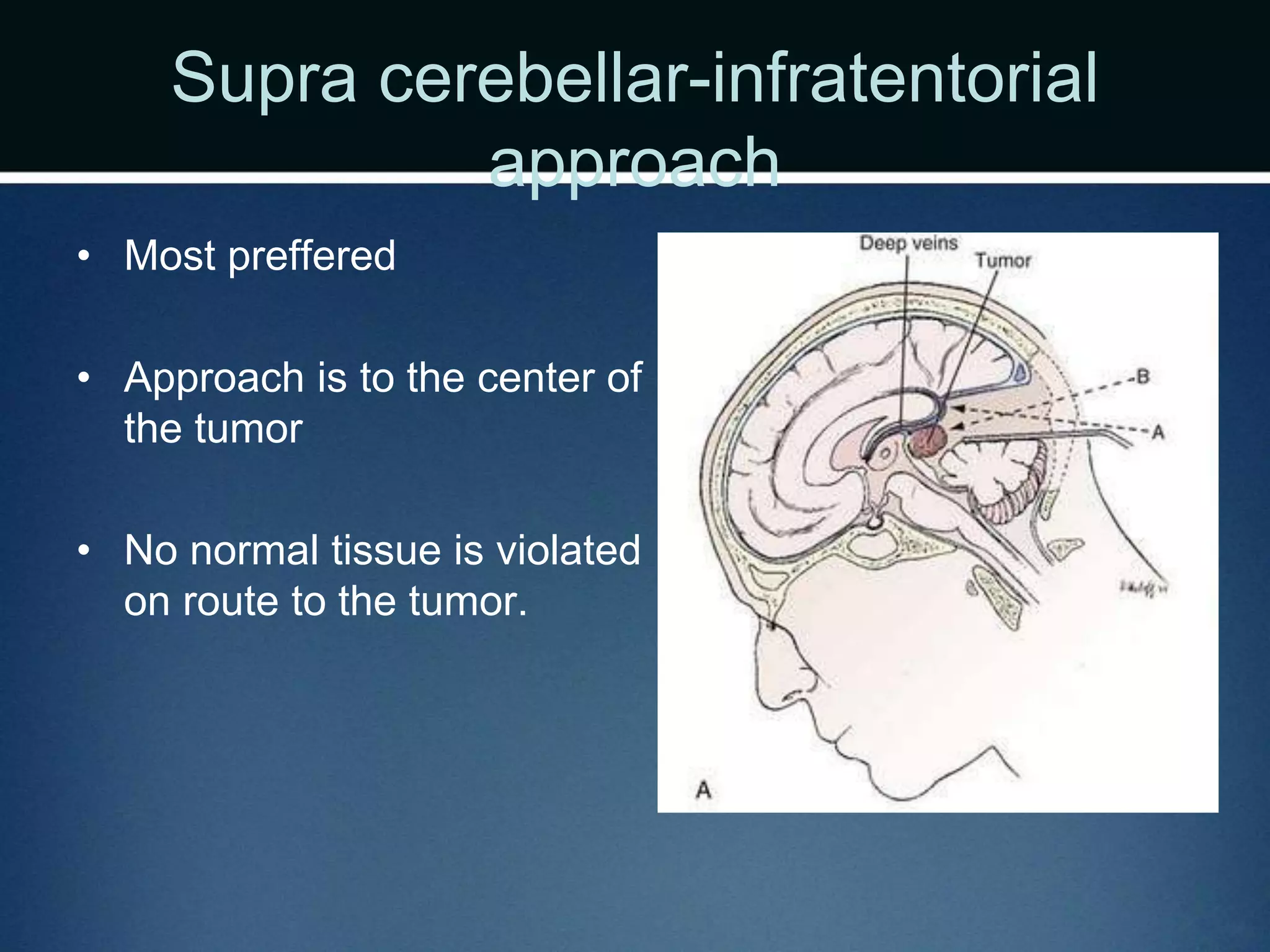 Pineal tumors | PPTX