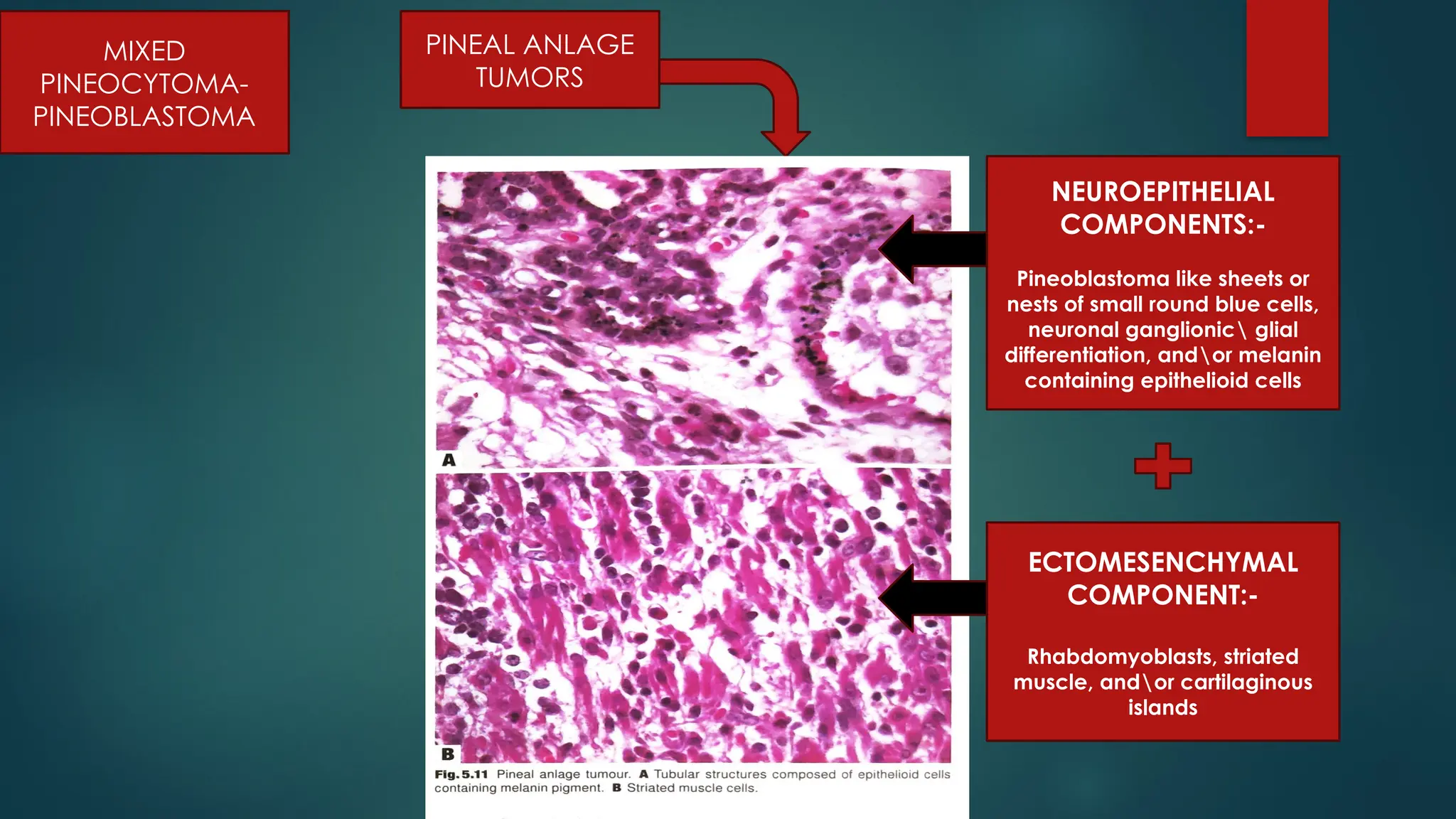 pineal gland tumors ( pineal gland )- approach | PPTX