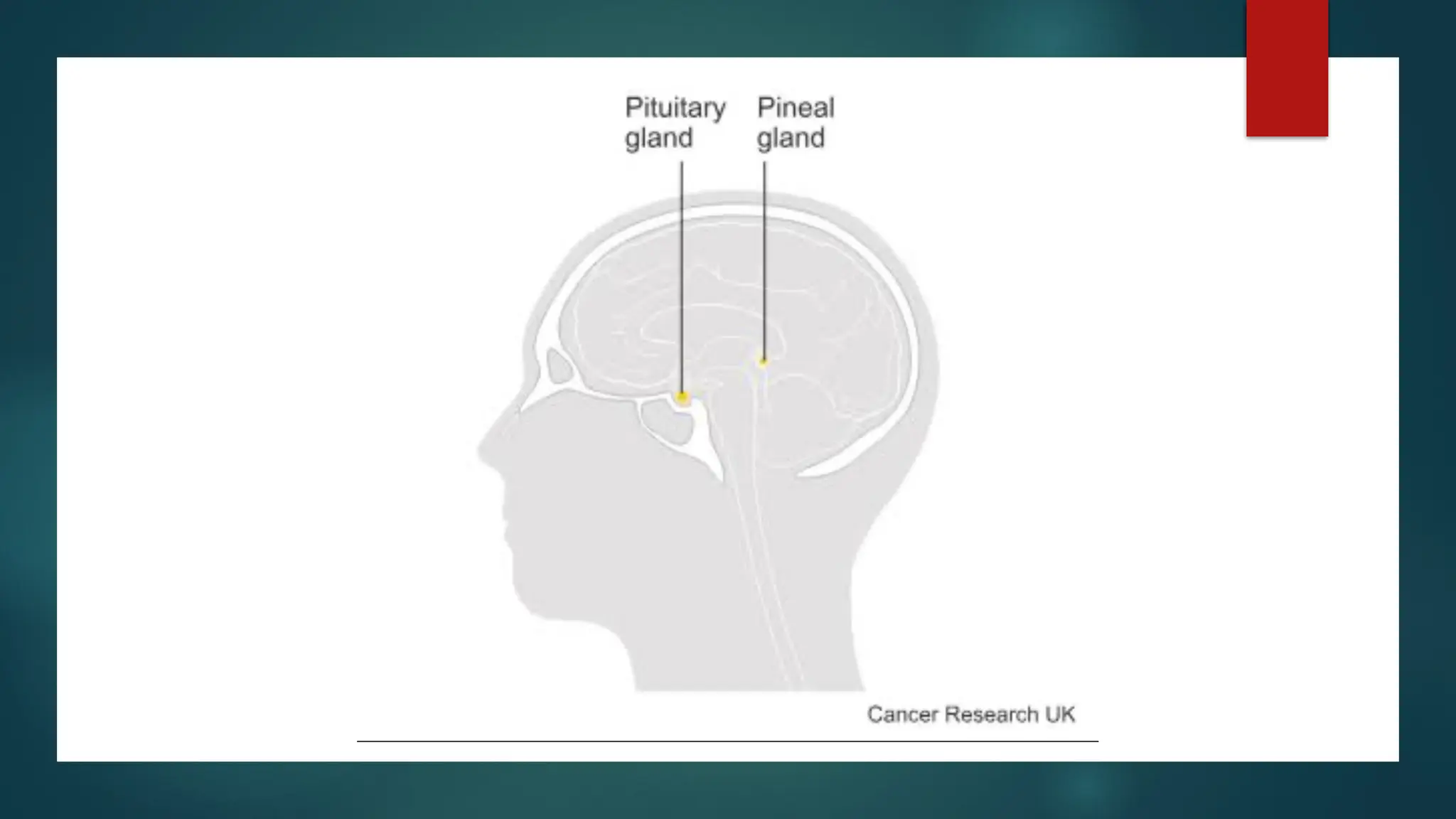 pineal gland tumors ( pineal gland )- approach | PPTX