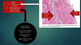 pineal gland tumors ( pineal gland )- approach | PPTX