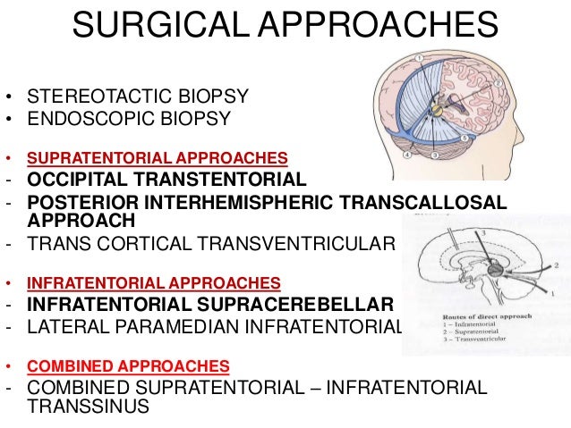 Pineal tumours treatment and approaches