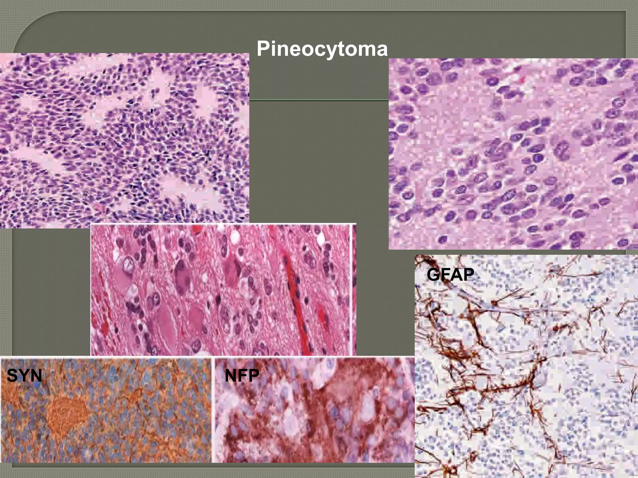 Pineoblastoma | PPTX