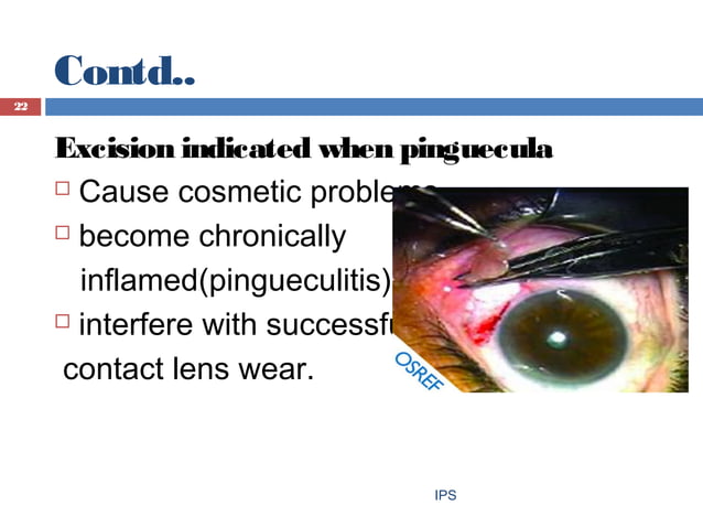 Pinguecula - An overview | PPT
