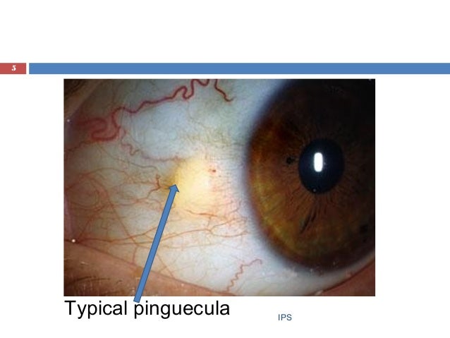 Pinguecula - An overview