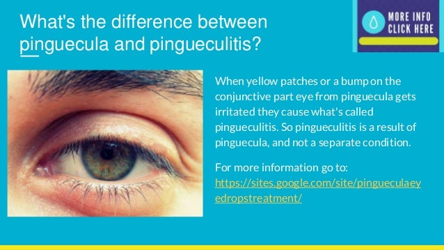 Pinguecula Eye Drops with Dipyridamole