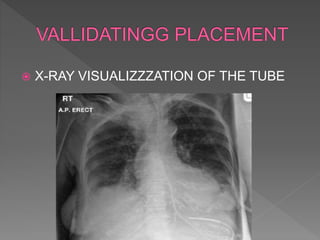 Pinkcity nursing classes ng tube | PPTX