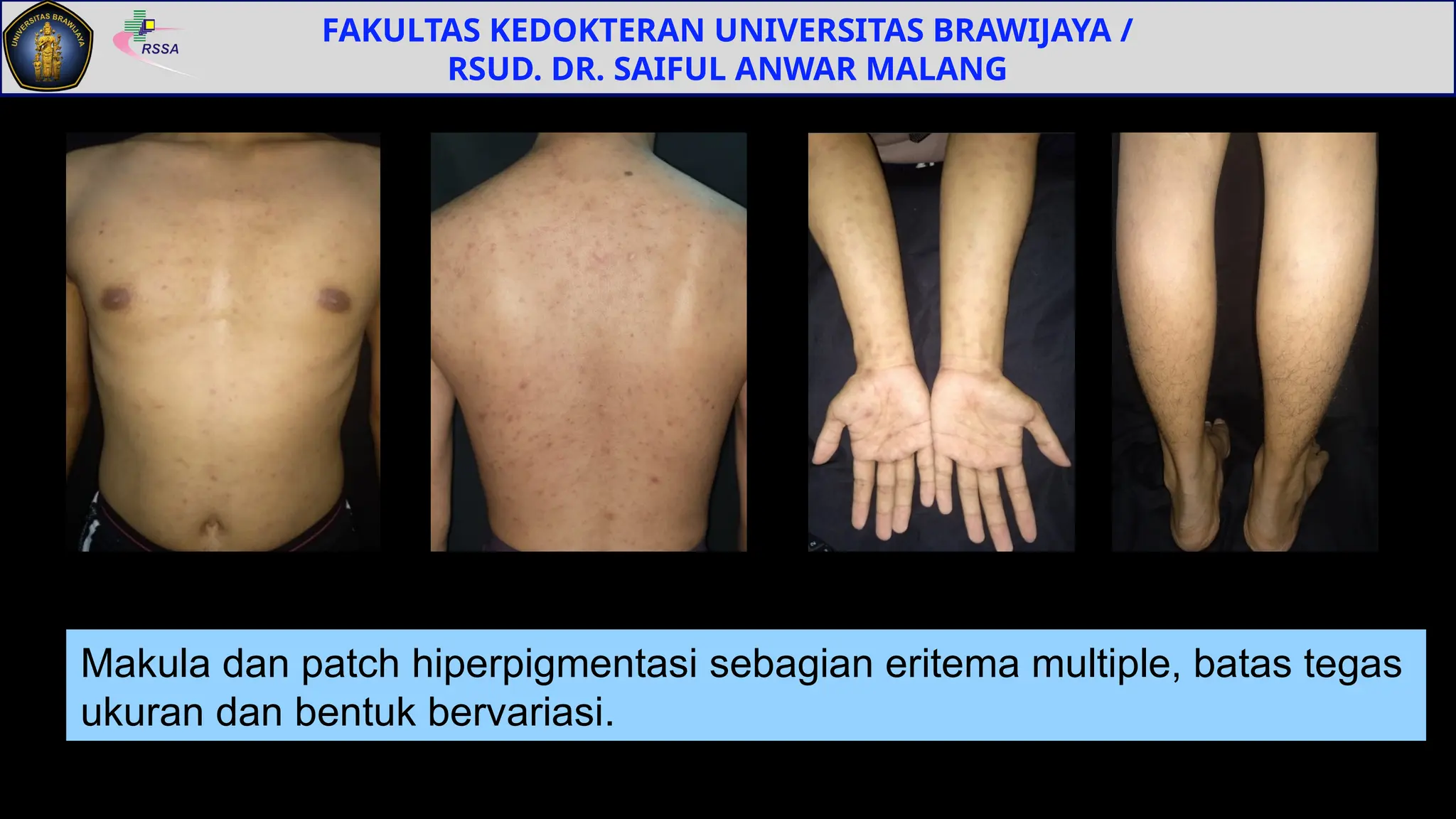 POLIPOID KONDILOMATA LATA PADA PASIEN SIFILIS SEKUNDER DAN HIV | PPTX