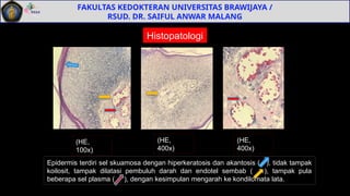POLIPOID KONDILOMATA LATA PADA PASIEN SIFILIS SEKUNDER DAN HIV | PPTX