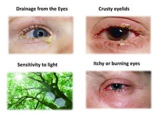 Pinkeye {conjunctivitis} | PPTX