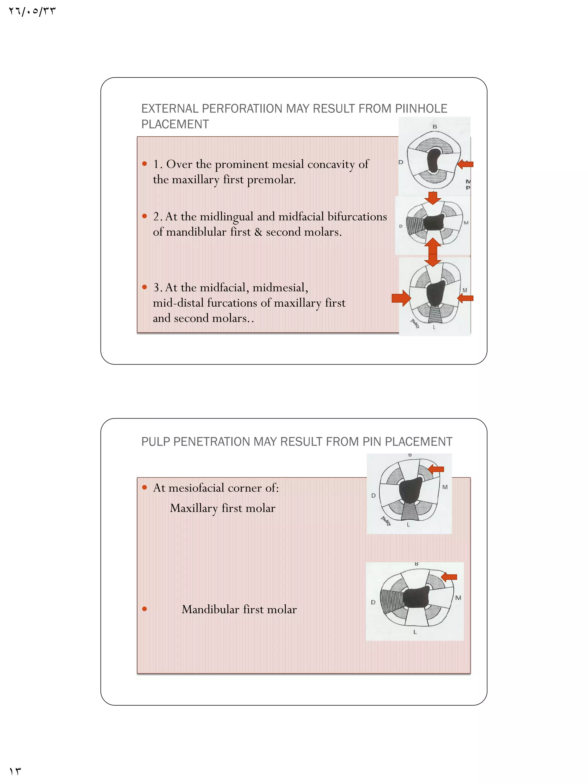 Pin retained amalgam restorations | PDF