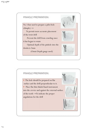 Pin retained amalgam restorations | PDF