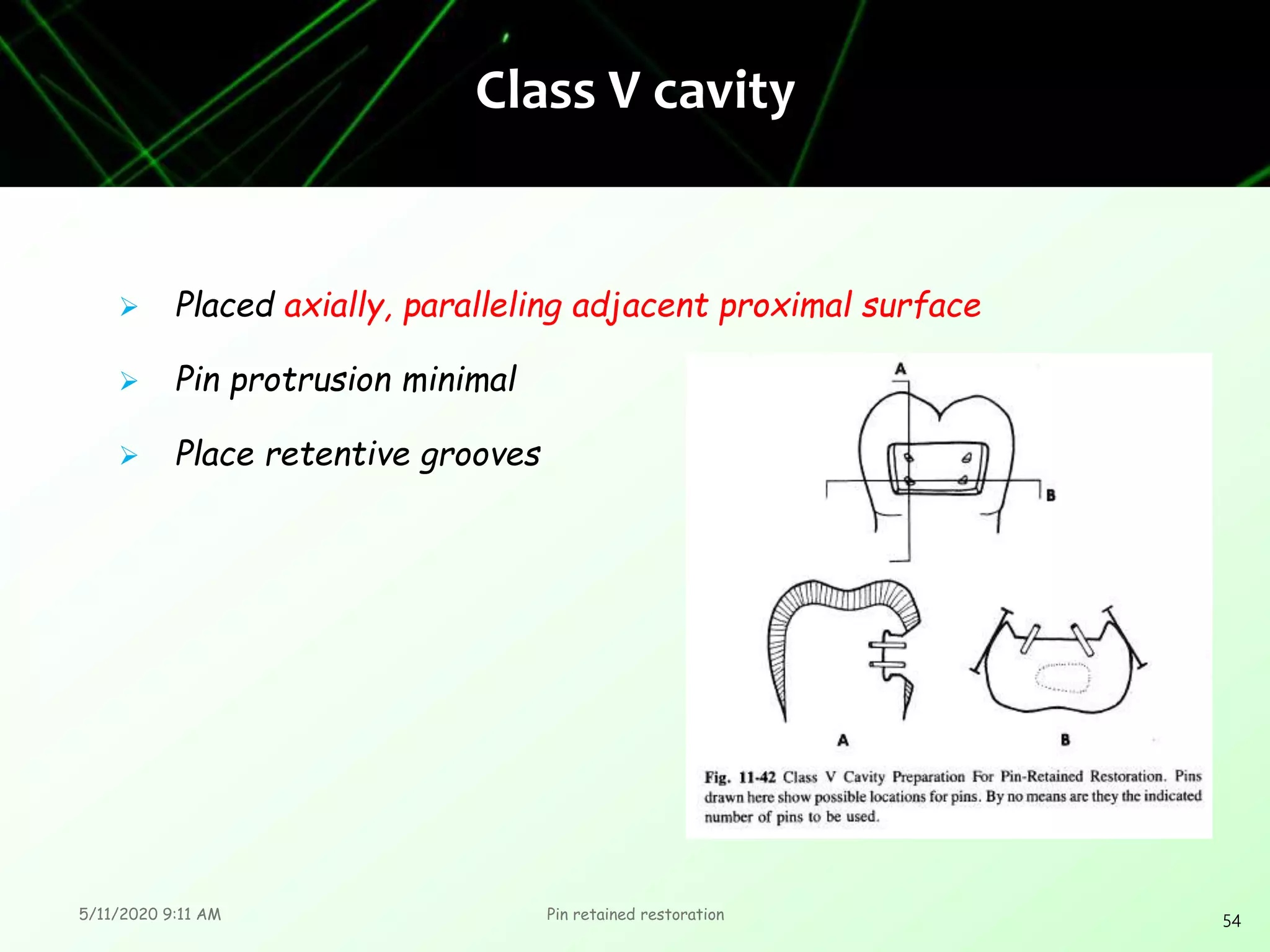 Pin retained restorations | PPTX