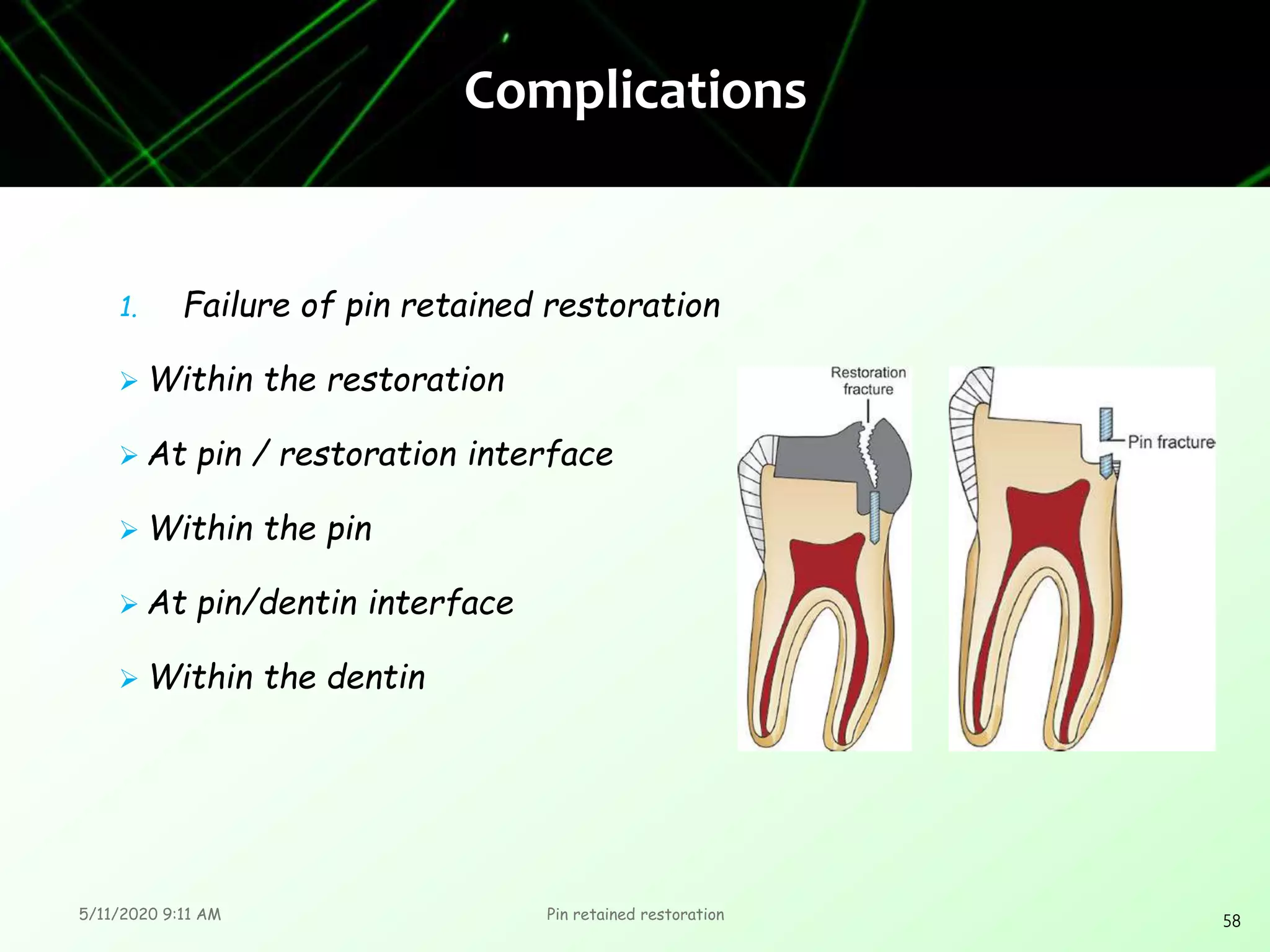 Pin retained restorations | PPTX