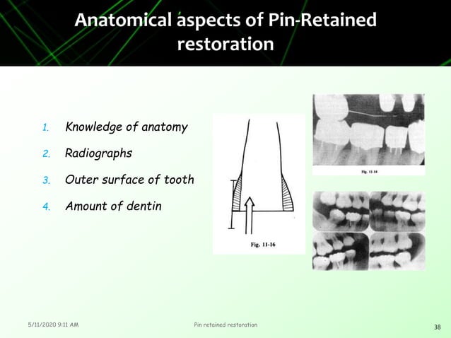 Pin retained restorations | PPTX