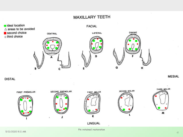 Pin retained restorations | PPTX