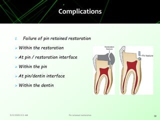 Pin retained restorations | PPTX