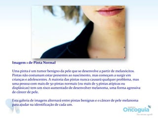 Pintas x Melanoma: Saiba Diferenciar | PPTX
