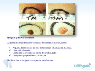 Pintas x Melanoma: Saiba Diferenciar | PPTX