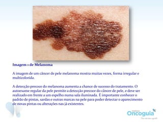 Pintas x Melanoma: Saiba Diferenciar