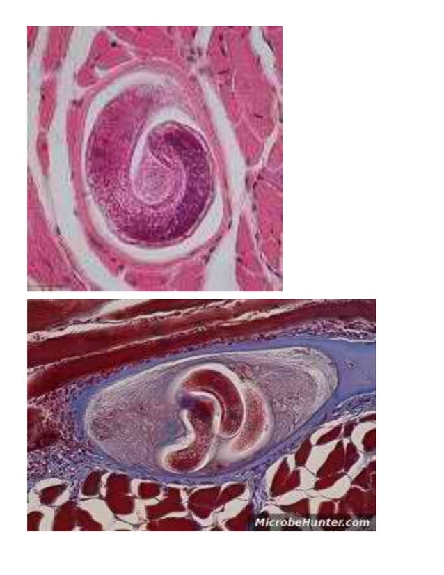 Pinworm | DOCX