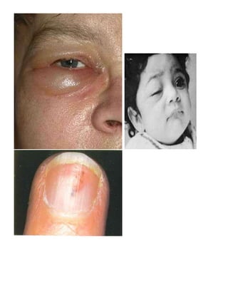 Pinworm | DOCX