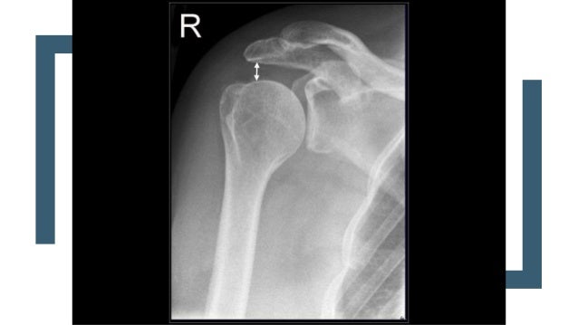 Pinzamiento subacromial