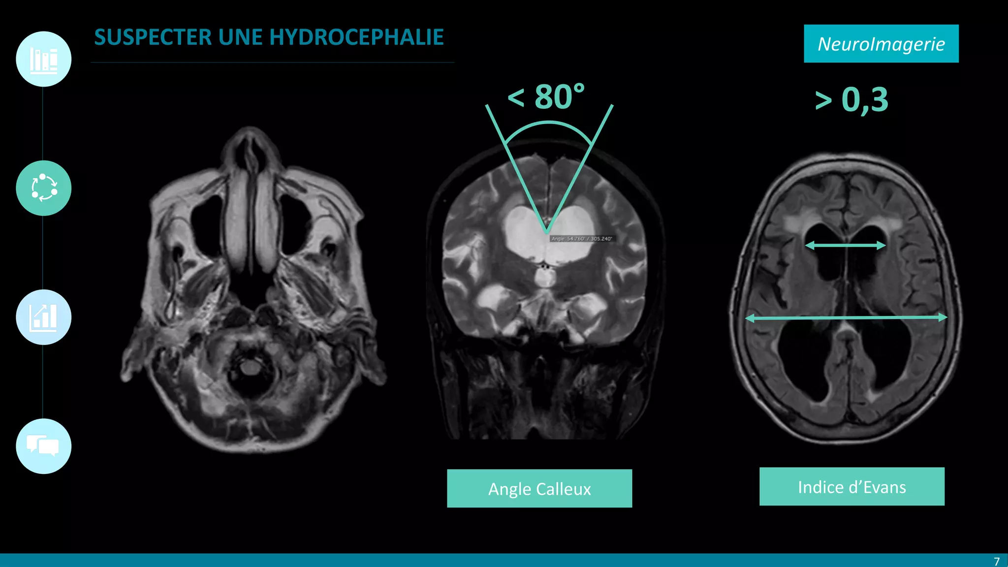 Pierre-Antoine PIOCHE - Hydrocéphalie et Désordre de Conscience | PDF