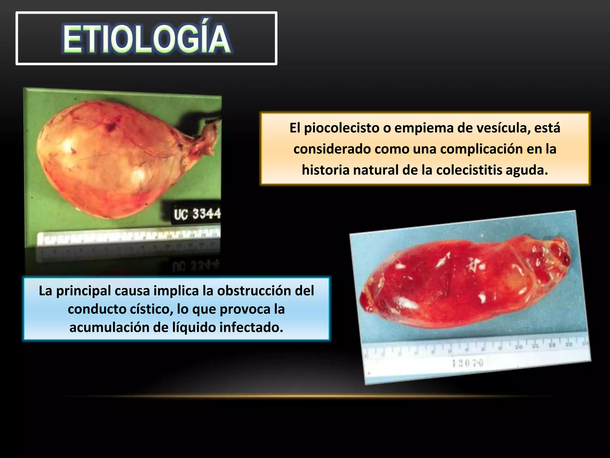 Piocolecisto | PPTX