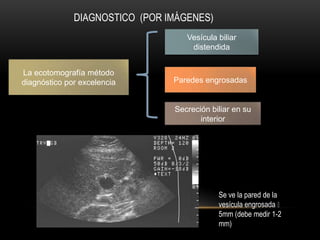 Piocolecisto | PPTX