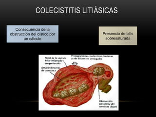 Piocolecisto | PPTX
