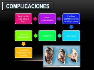 Piocolecisto | PPTX