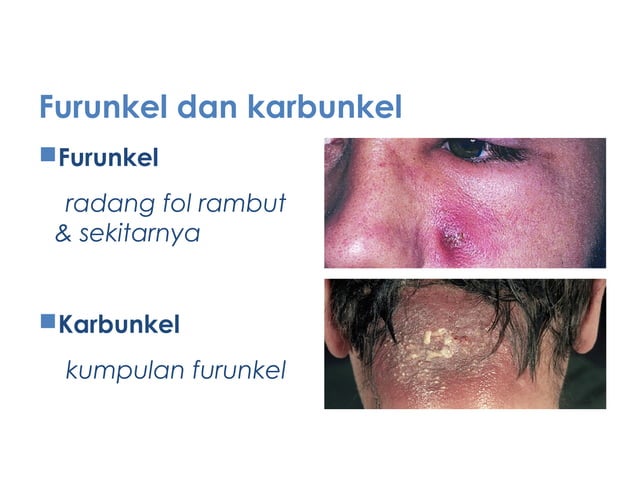 Pioderma - Infeksi Kulit | PPT