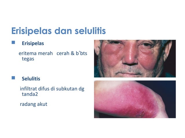 Pioderma - Infeksi Kulit | PPT