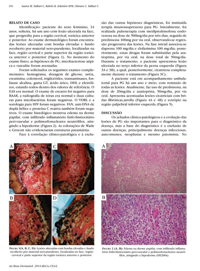 Pioderma Gangrenoso