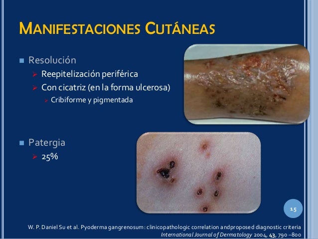 Pioderma gangrenoso