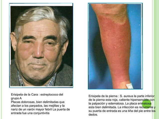 Piodermitis completo | PPTX