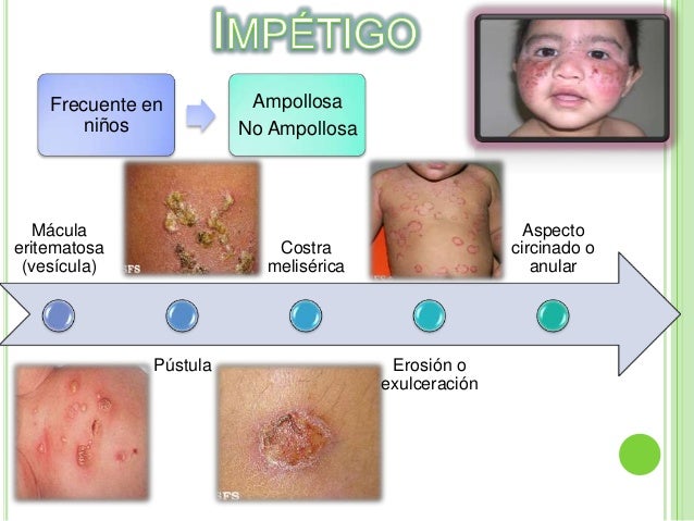 Piodermitis completo