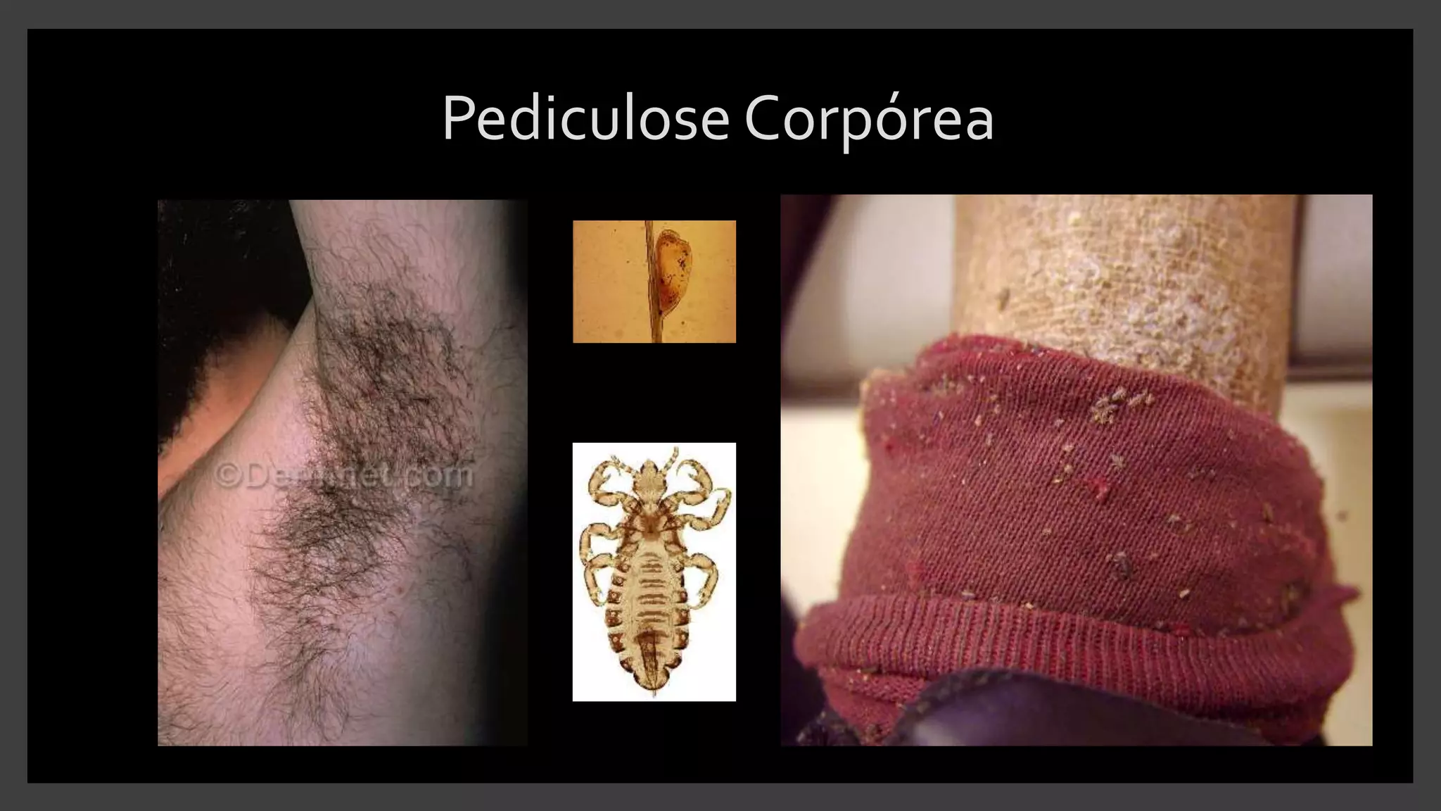 Escabiose e Pediculose | PPSX | Infectious Diseases | Diseases and ...