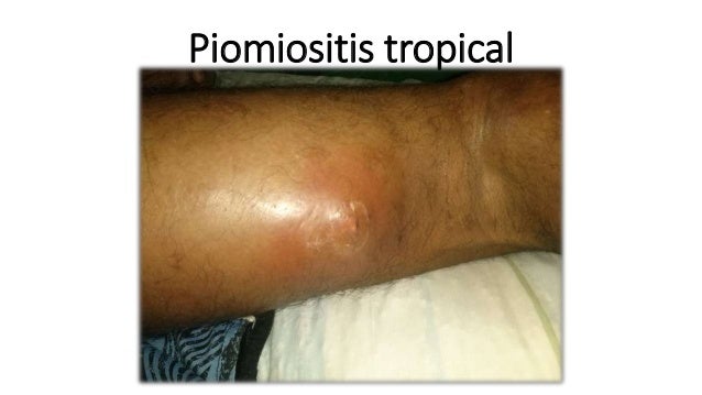 Piomiositis tropical