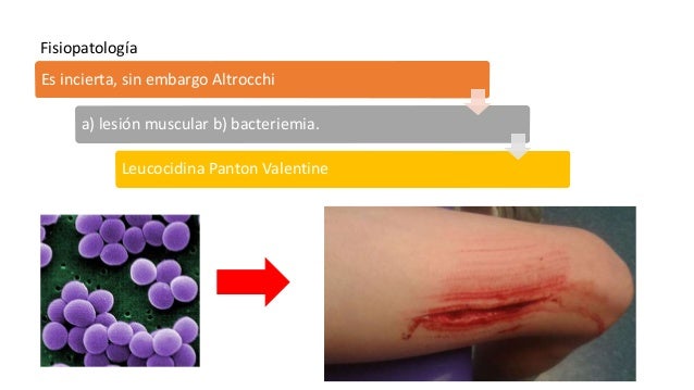 Piomiositis tropical
