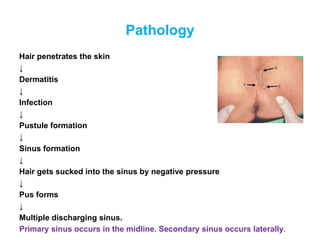 Pionidal sinus | PPT
