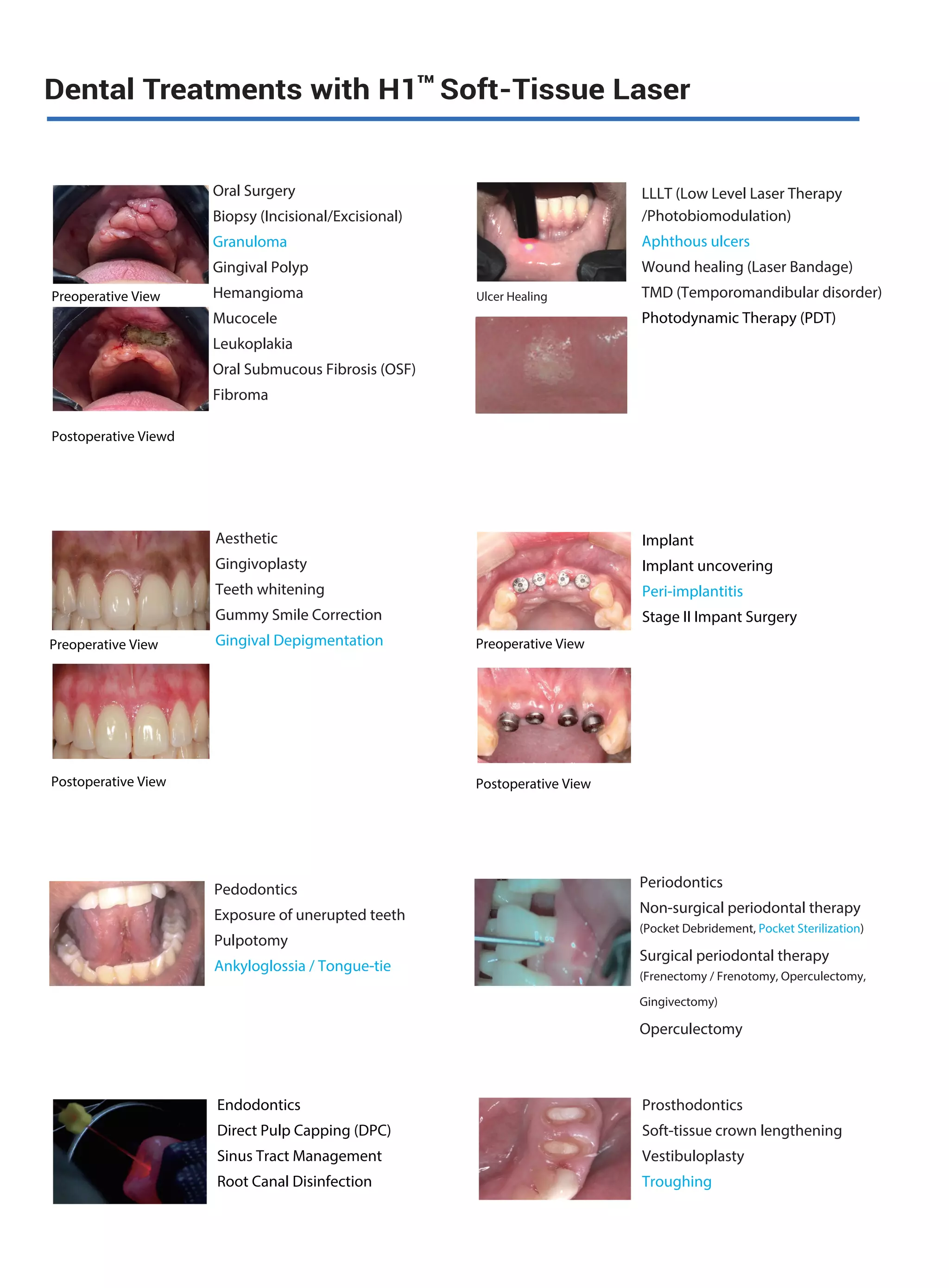 Pioon H1 dental laser.pdf