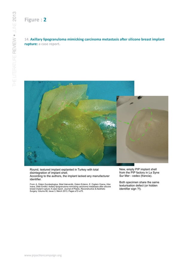 P.I.P. Breast Implants The Literature Review June 2013 | PDF