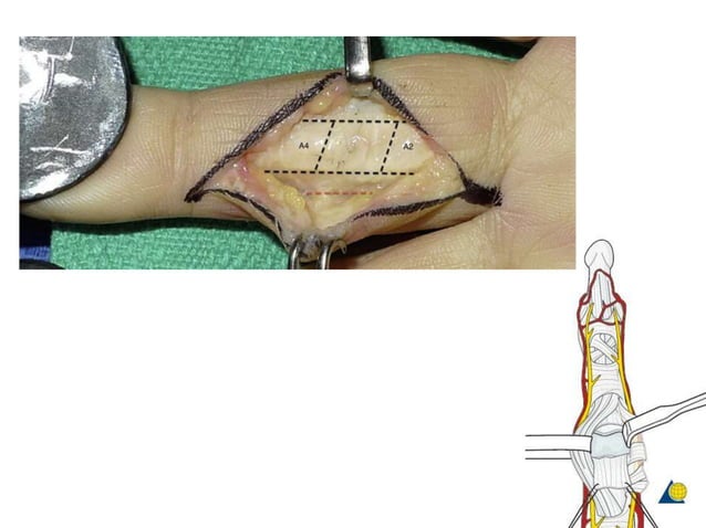 PIP joint approach | PPTX