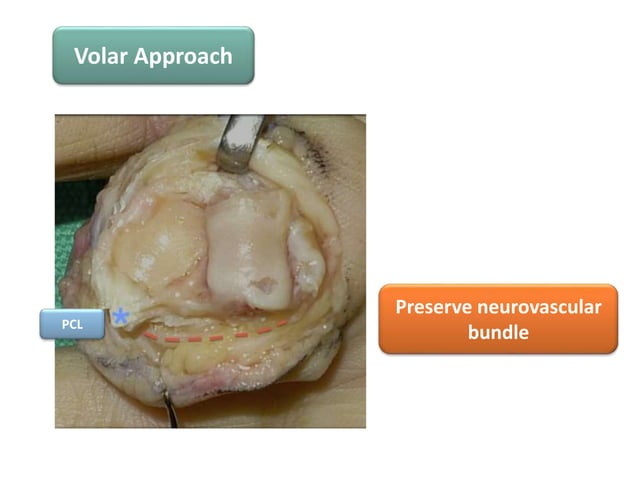 PIP joint approach | PPTX