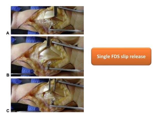 PIP joint approach | PPTX
